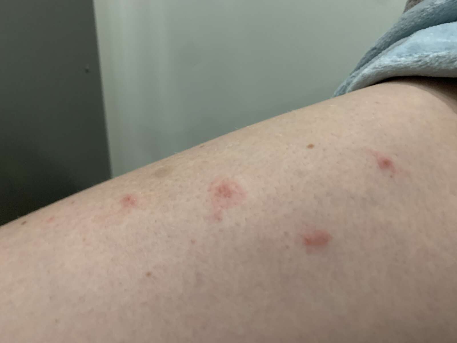 Mite Bites Mite Bites